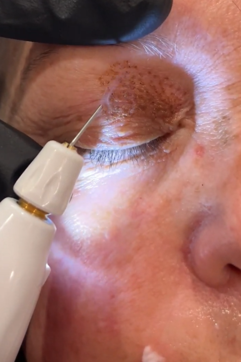 Plexr Skin Tightening: Smooth Wrinkles & Rejuvenate Eyes, No Surgery